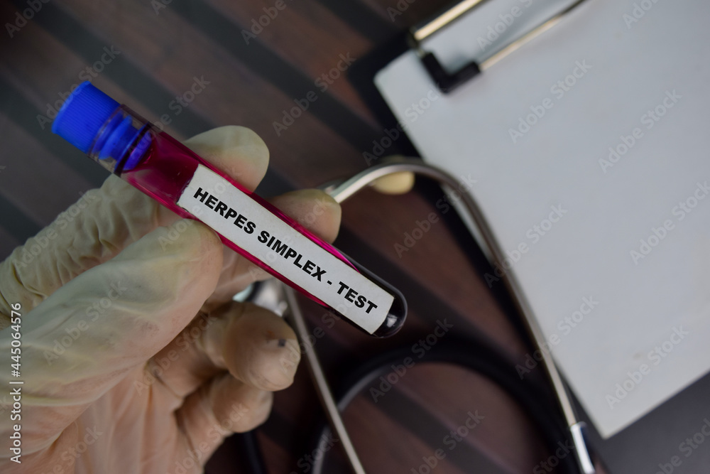 Herpes Simplex - Test Test with blood sample. Top view isolated on ...
