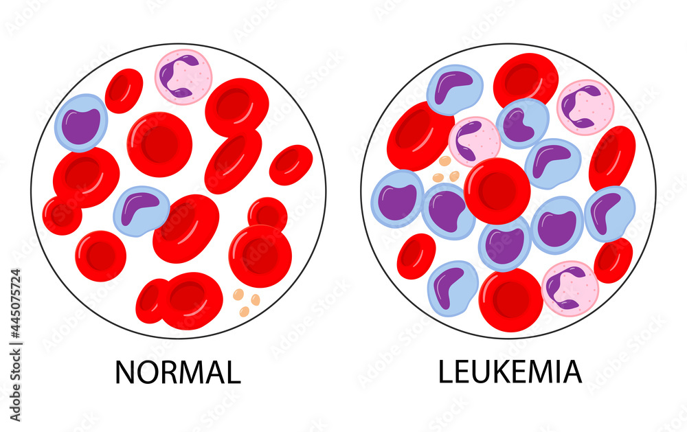 Leukemia Cells Compared To Normal Cells