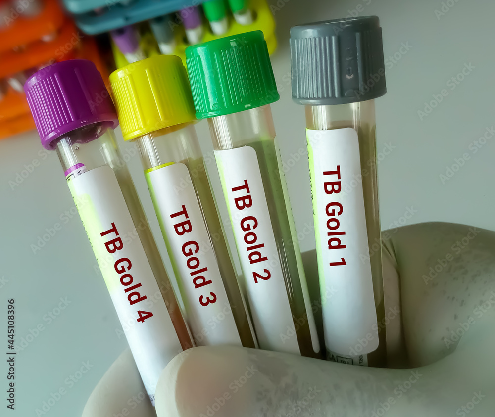 Close view of scientist hand hold blood samples for TB Gold or ...