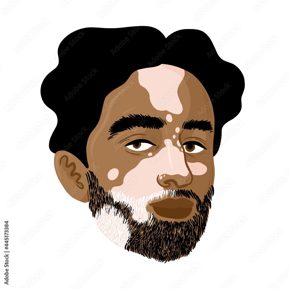 Man with vitiligo and dark hair. Spotted black and white beard. Stock ...
