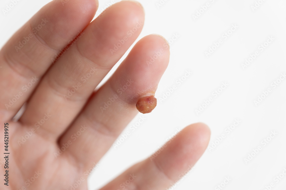 Protruding soft tissue tumor in finger on white background Stock Photo ...