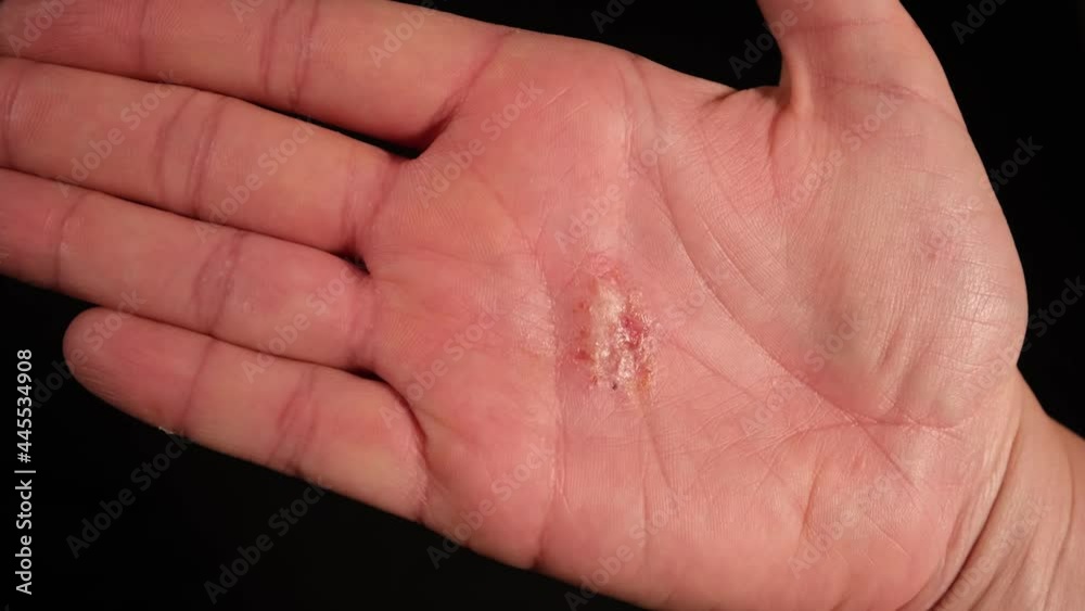 Close up view on cracked dry skin of palm. Woman's hand with psoriasis ...
