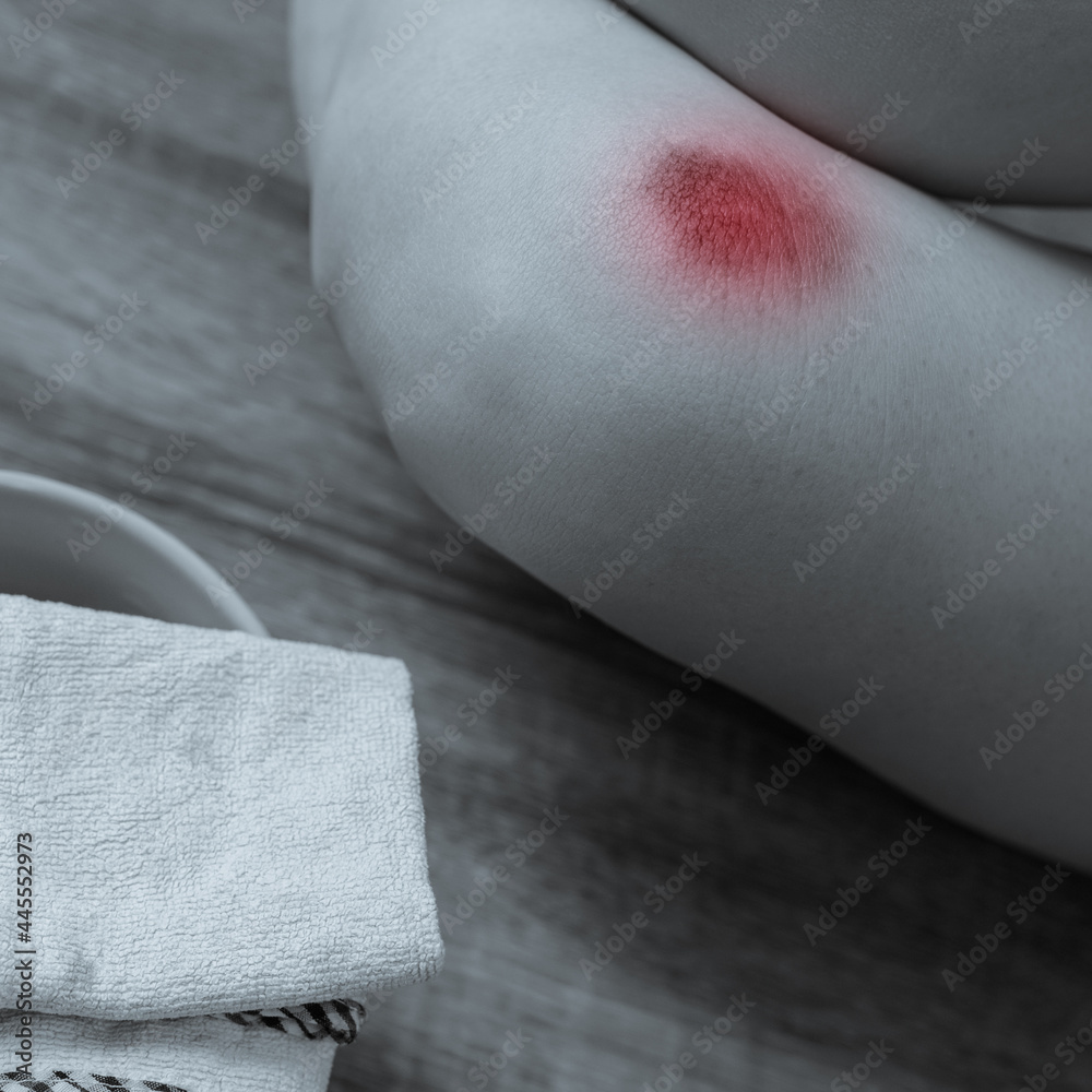 Monochrome photo of woman suffering from bleeding wound on her knee ...