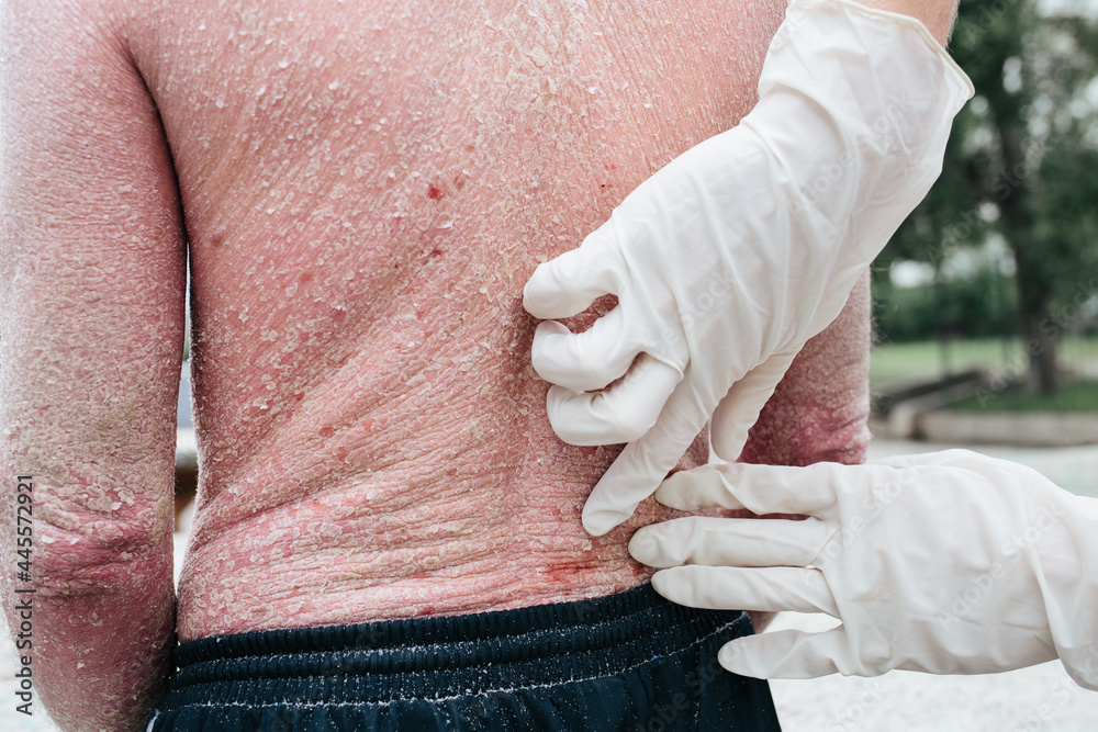 Foto de Doctor examining patient with psoriasis on back, closeup ...