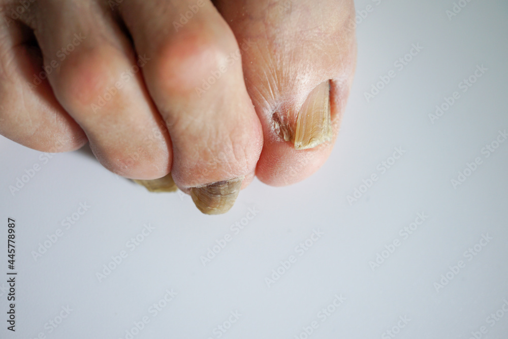 old mans foot with nail fungus and crooked toes - close up foot of an ...