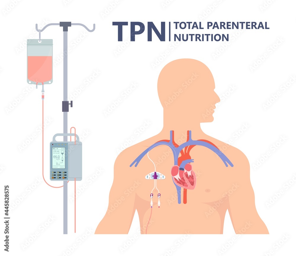 TPN PPN Total tube nutritional partial line PICC IV care unit ICU tract ...
