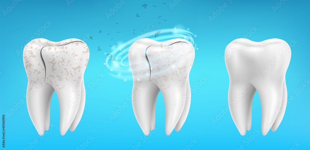 3d realistic clean and dirty tooth set on blue background, Teeth ...
