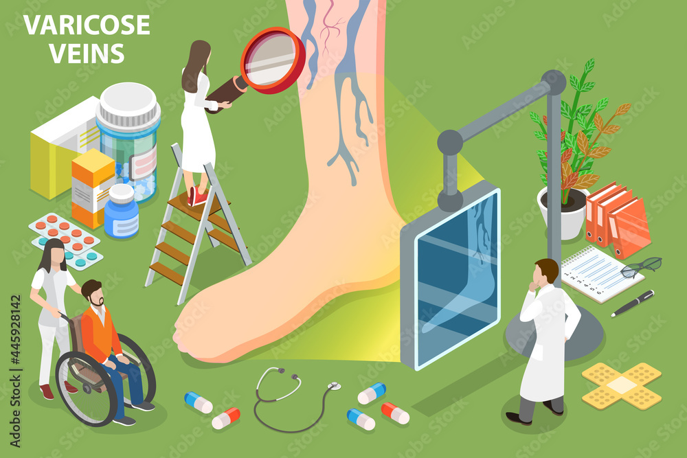 3D Isometric Flat Vector Conceptual Illustration of Varicose Veins ...