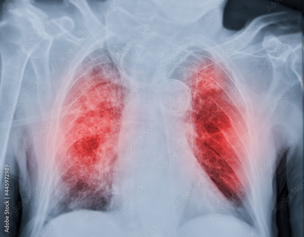 Chest X-ray Of Human Chest or Lung ( red zone ) showing tuberculosis ...