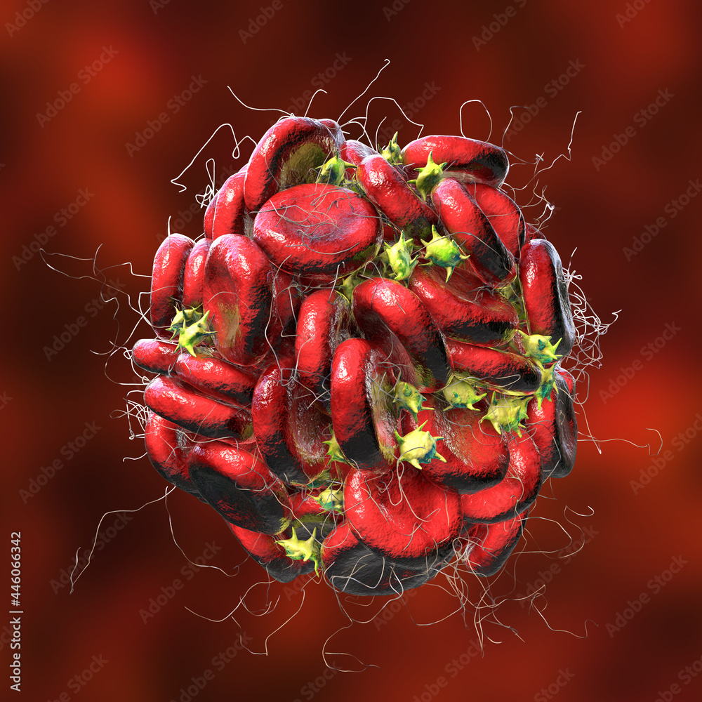 Blood clot made of red blood cells, platelets and fibrin protein ...