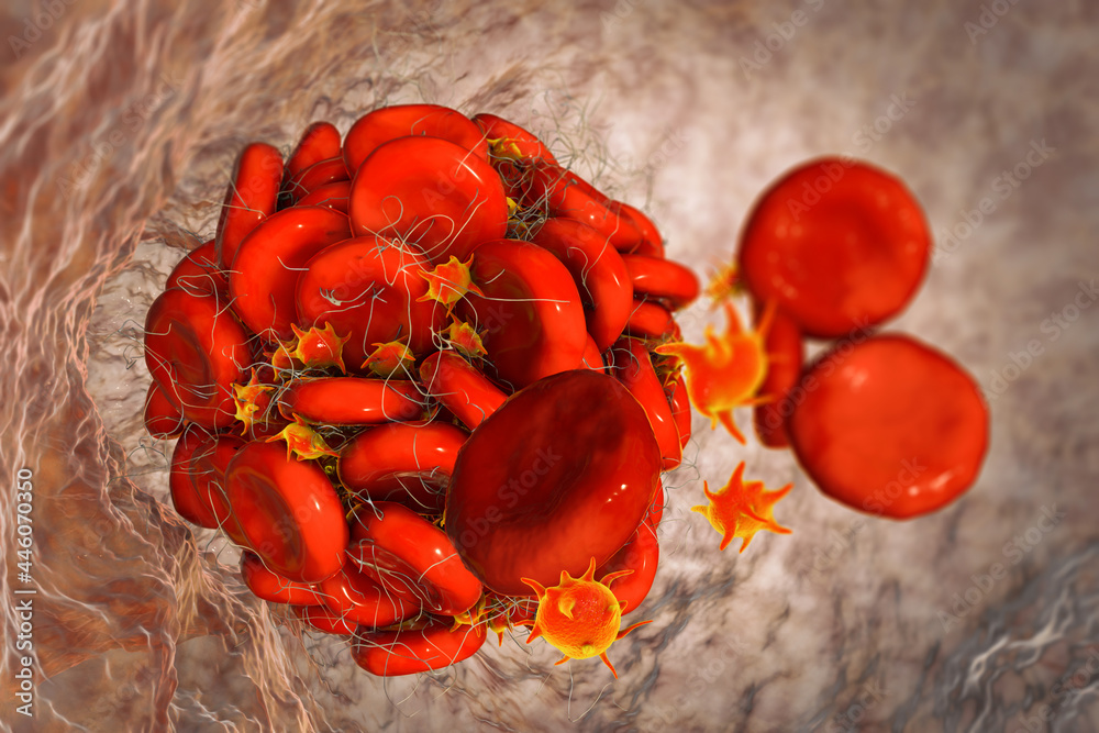 Blood clot made of red blood cells, platelets and fibrin protein ...