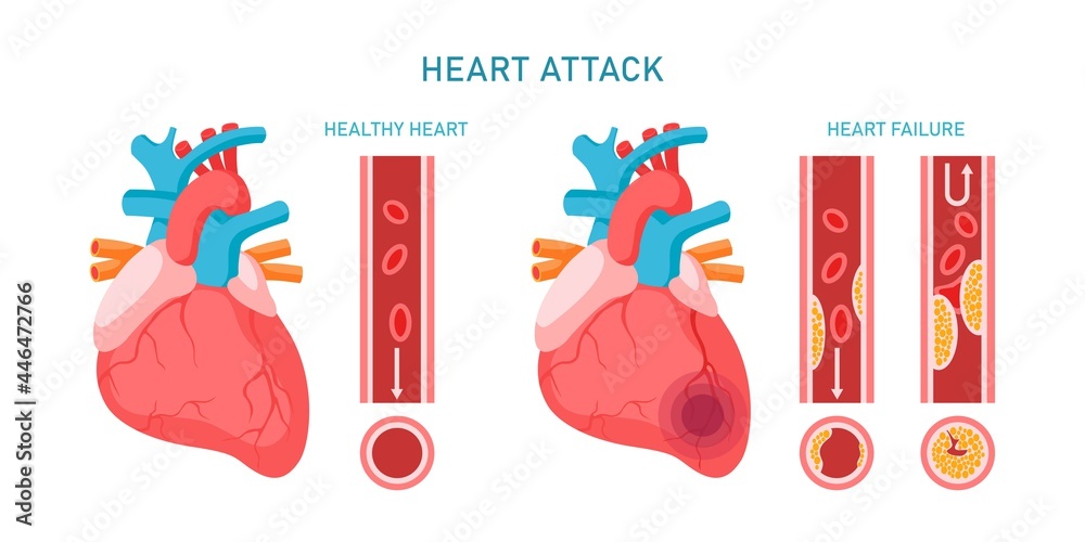 Cardiovascular Disease Heart