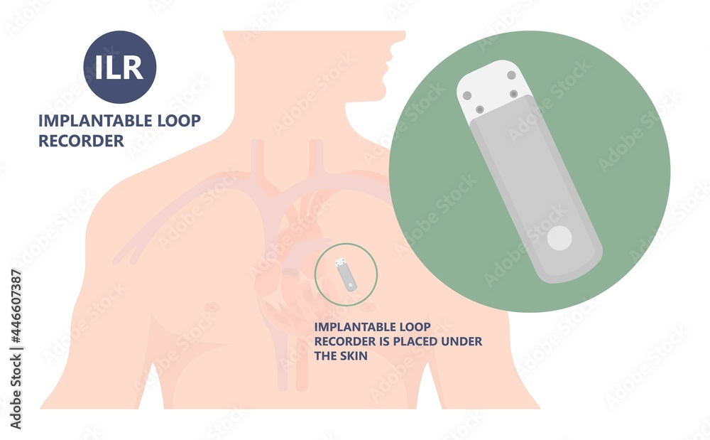 loop holter event atrial heart attack stroke ECG EKG device monitoring ...
