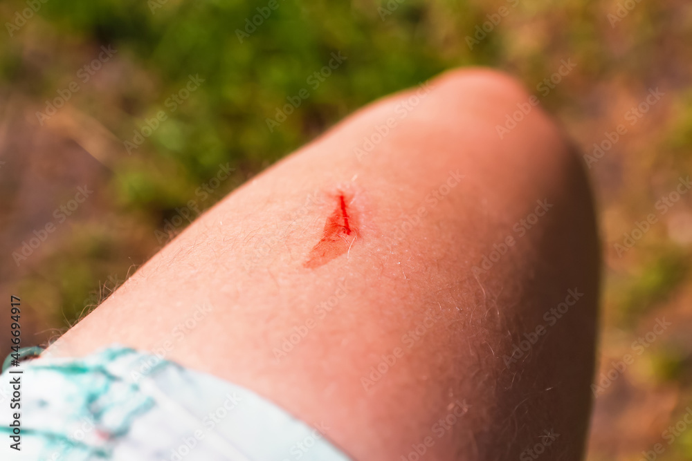 Fresh wound on the leg, thigh with blood. Skin texture. Body positive ...