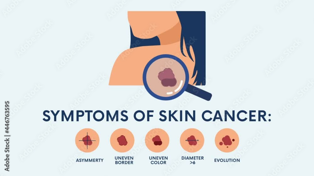 Skin cancer symptoms 2D animation on transparent background. Melanoma ...