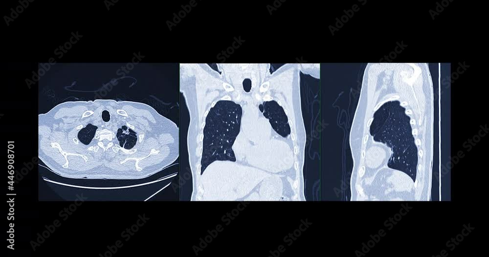 Compare of CT Chest or CT Scan of Lung Axial ,Coronal and sagittal MIP View for diagnosis TB ...
