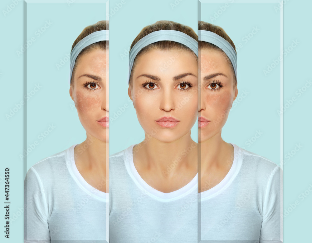 Dark spots, freckles,hyperpigmentation(melasma or chloasma),concept ...