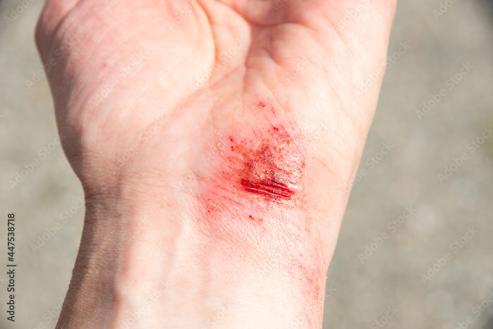 Bloody wound on the palm, arm, wrist after an accident or fall. Sport injury - painful hand ...