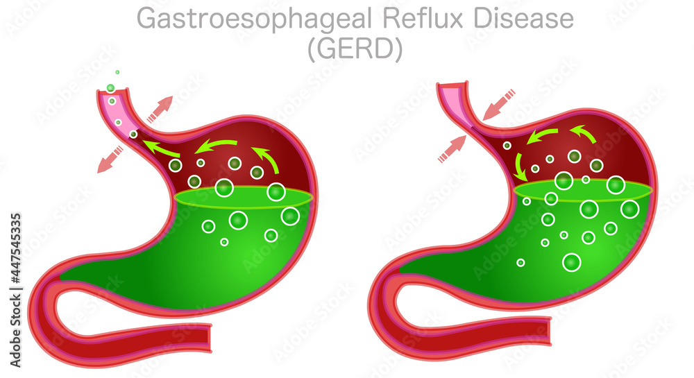 Gastroesophageal Reflux Disease GERD. Stomach anatomy structure ...