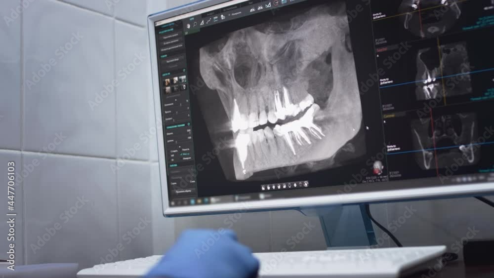 Dentist doctor examines a panoramic x-ray of the jaw on a computer ...