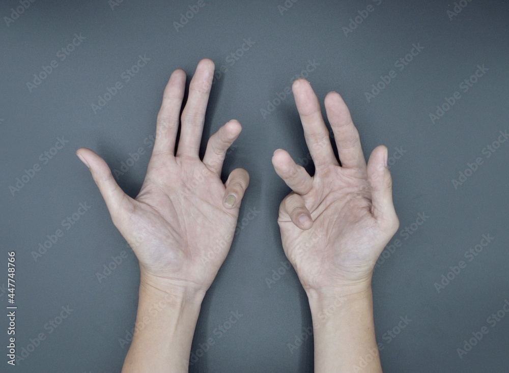 Bilateral Dupuytren’s contracture in Asian young man. Bilateral hand ...