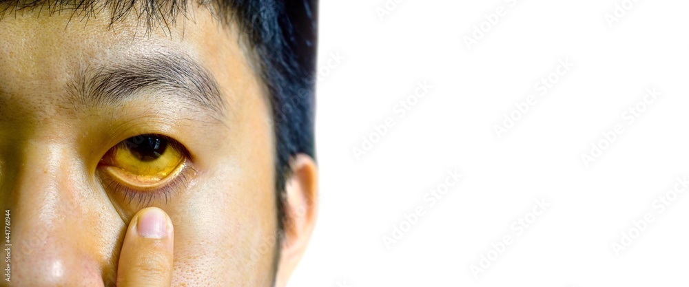 Deep jaundice in Asian male patient. Yellowish discoloration of skin ...