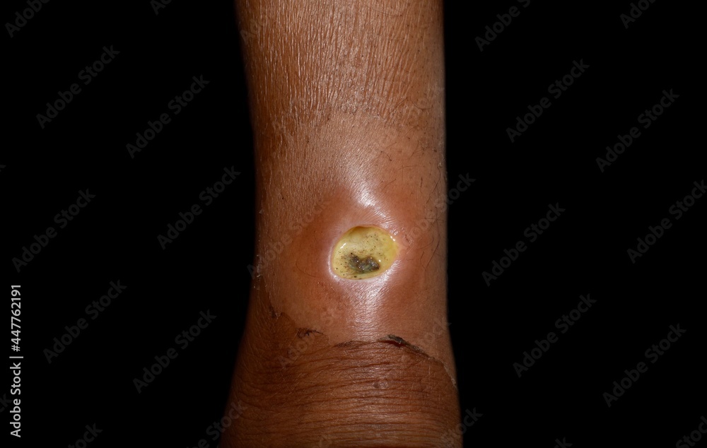 Diabetic ulcer in leg of Asian. patient. Poor wound healing. Stock ...