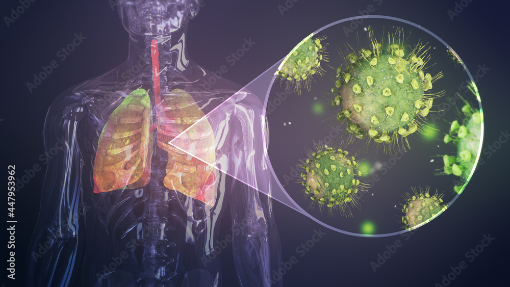 Respiratory disease inside lungs. Pneumonia. Influenza type virus ...