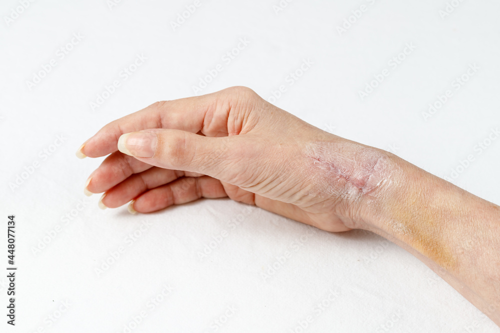 Applying a special medical cream or salve to a healing scar after ...