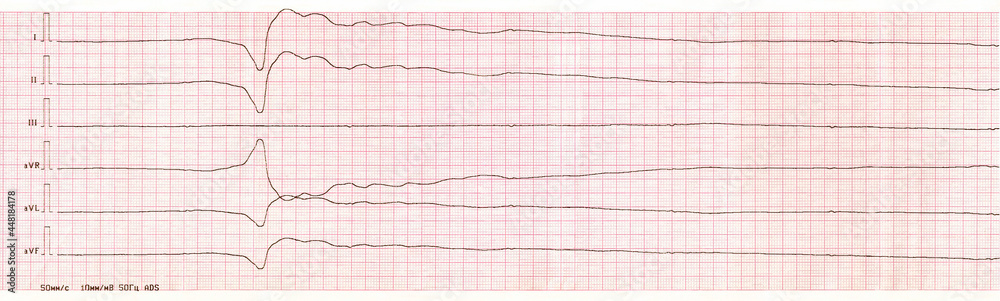ECG tape with single idioventricular complex and ventricular asystole ...