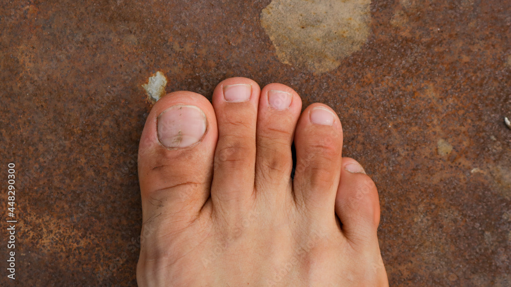 Male Foot with second toe longer than a big toe. Mortons's toe, Greek ...