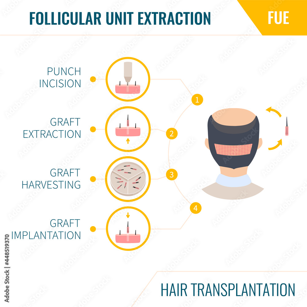 FUE hair transplantation infographics. Male alopecia treatment method ...