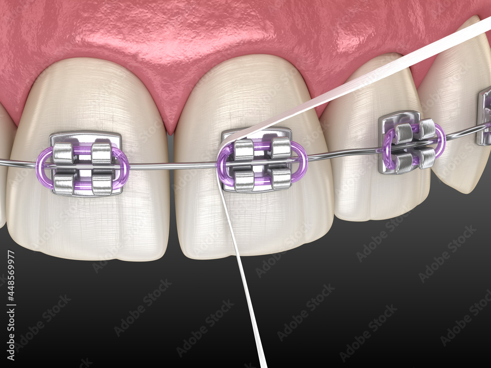 Dental floss cleaning braces process. Medically accurate 3D ...