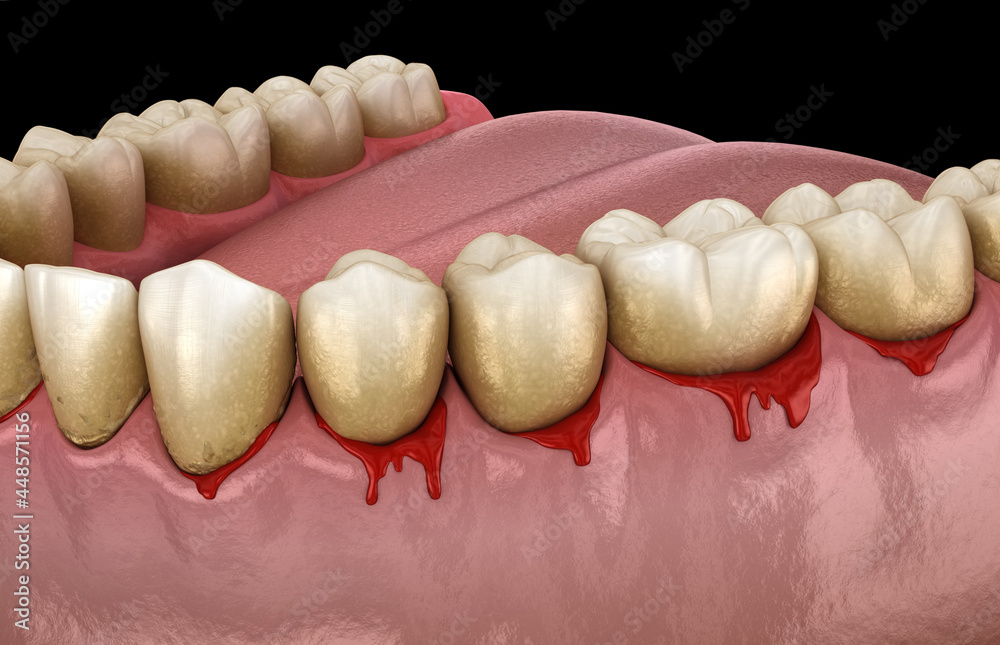 Bleeding gums or Periodontal - pathological inflammatory condition of ...