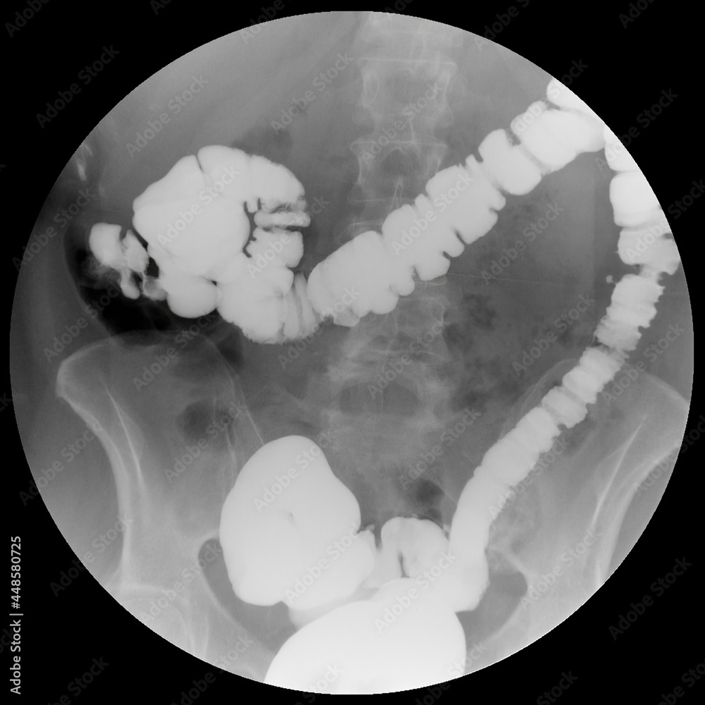 Barium enema image or x-ray image of large intestine or colon showing ...
