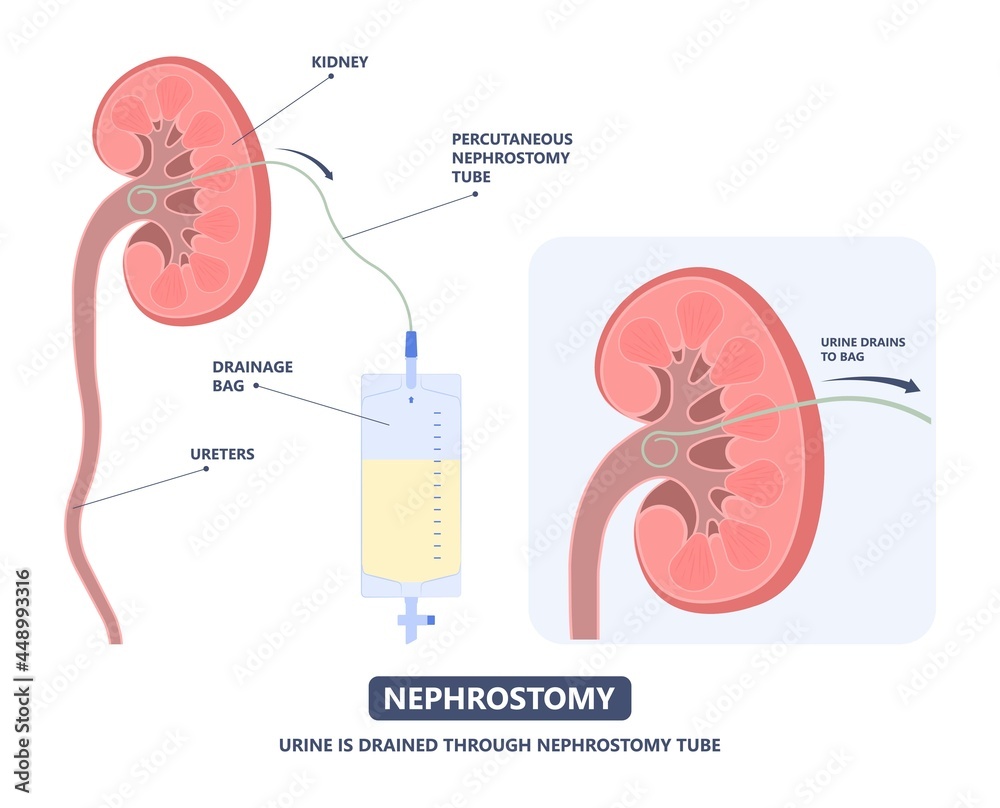 Tube Stent bag blocked kidney stone tumor urine urinary Drain renal ...