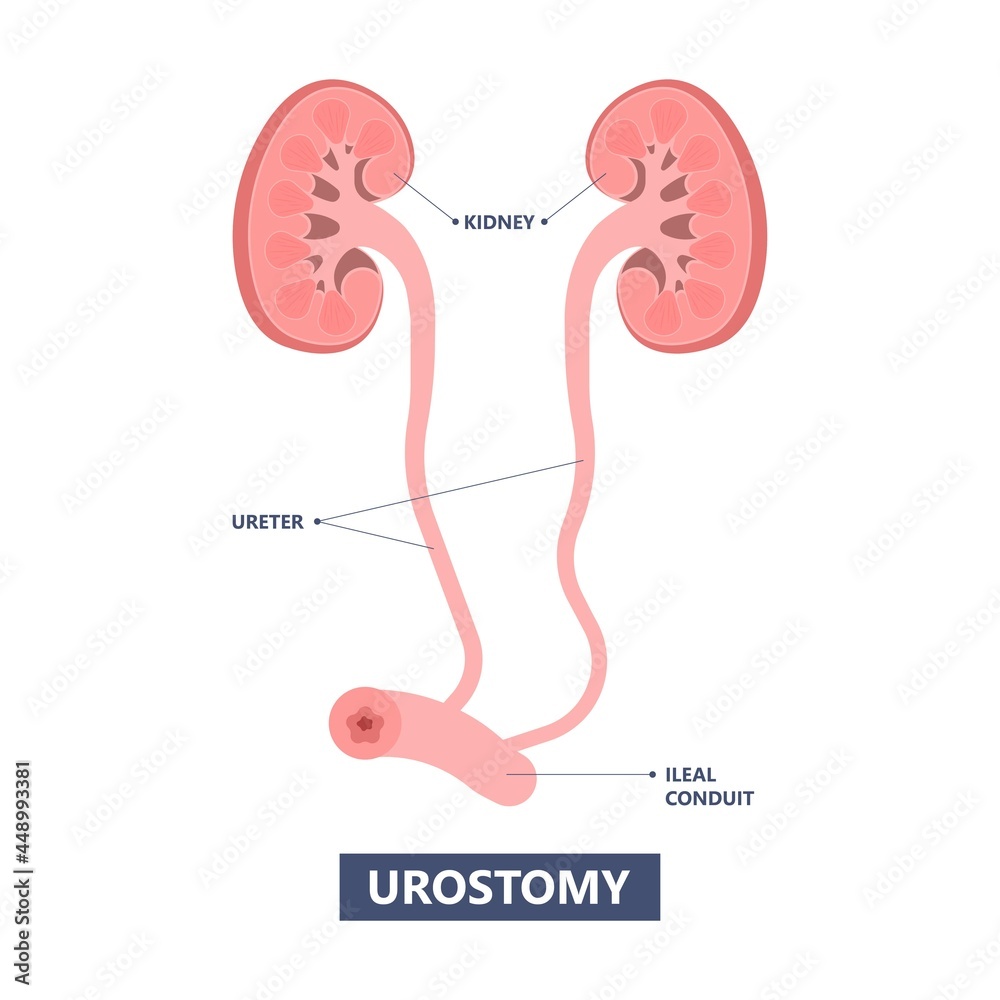 Tube Stent bag blocked kidney stone tumor urine urinary Drain renal ...