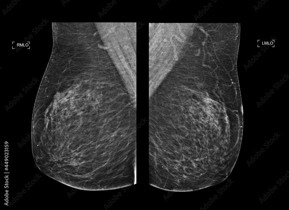 X-ray Digital Mammogram or mammography both side of the breast CC view ...