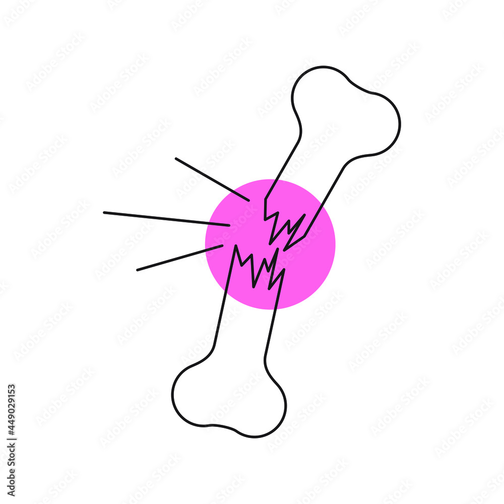 Bone contour. Bone fracture. Vector illustration. Stock Vector | Adobe ...