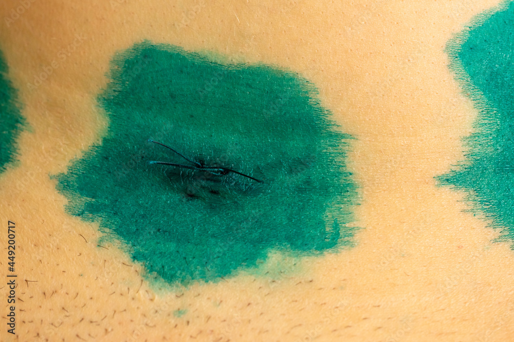 Surgical suture with brilliant green after laparoscopic surgery on ...