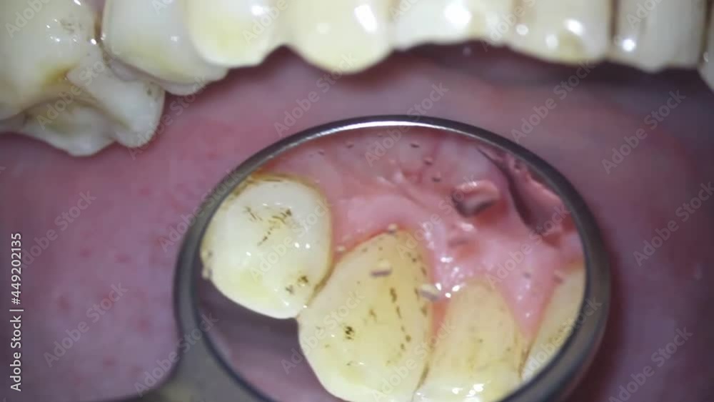 dentistry. shooting with a microscope. dental treatment. examination of ...