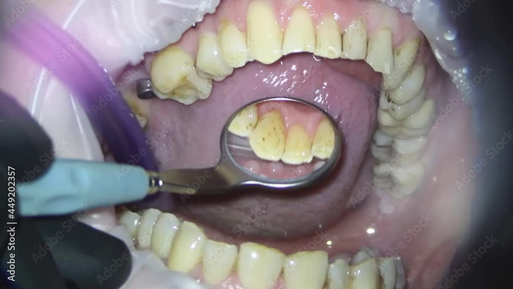 dentistry. shooting with a microscope. dental treatment. we clean the ...