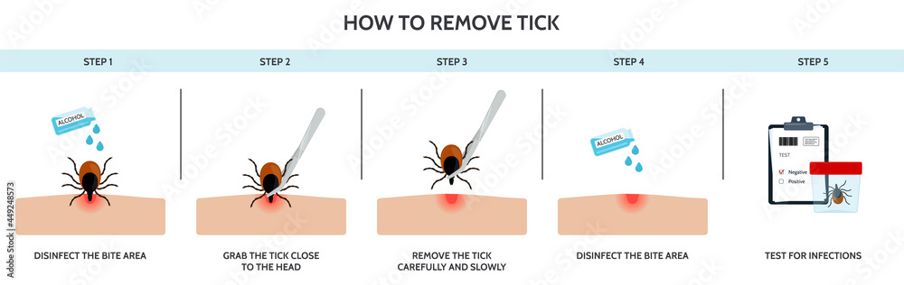 Vetor de The correct way to remove a tick insect correctly. Prevention ...