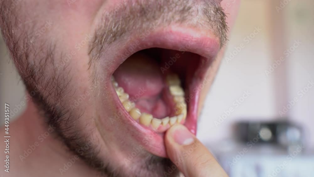 Close-up. Open Male Mouth with Teeth. Man Shows Teeth. Filled Tooth in ...