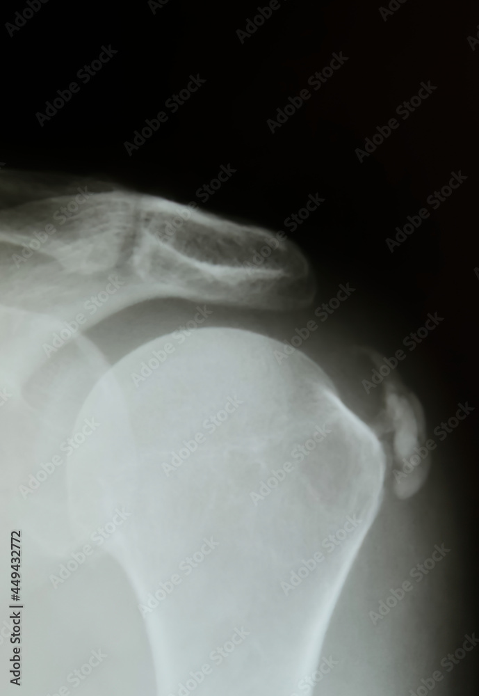 X-Ray image of calcified shoulder (Tendinosis calcarea) Stock Photo ...