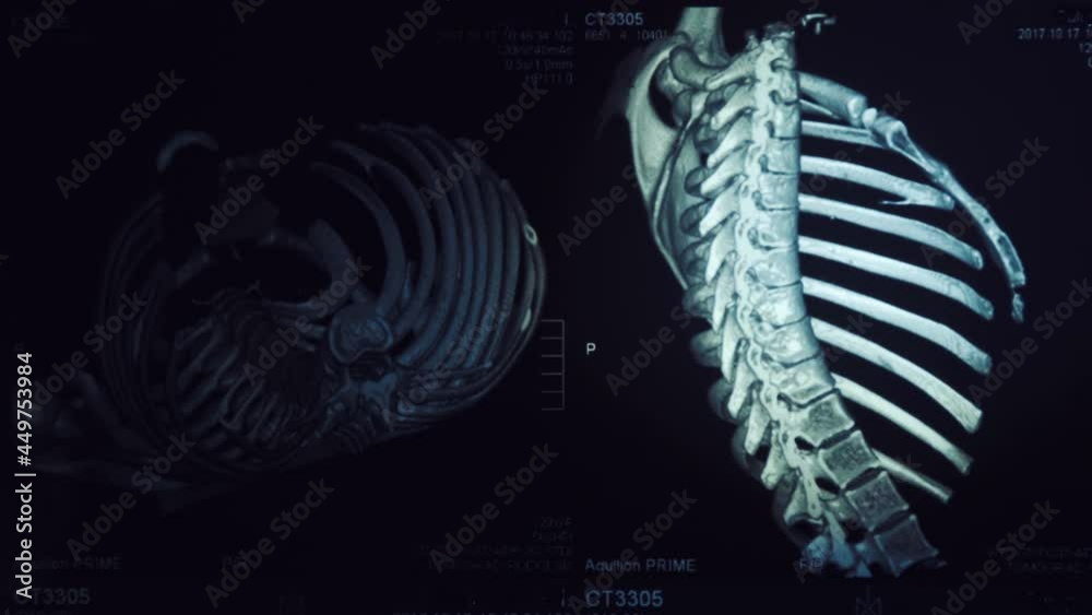 Magnetic resonance imaging (MRI) of the human chest with ribs and spine ...