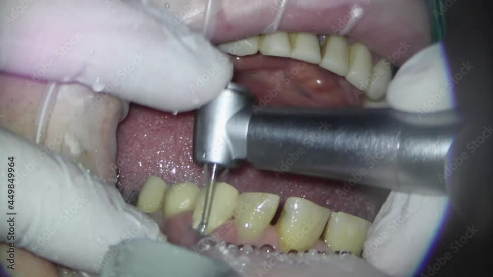 dentistry. shooting with a microscope. necrectomy. the dentist removes ...