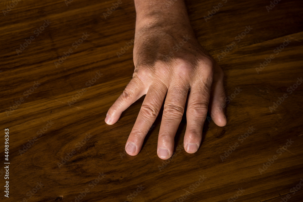 Photo & Art Print The hands of a male with Psoriatic Arthritis showing ...