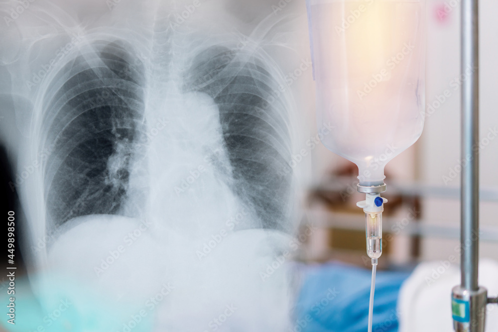 X-Ray Image of human lungs for a medical coronavirus covid-19 diagnosis ...