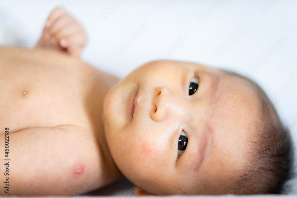 Asian baby on white bed with reaction of Bacillus Calmette Guerin or ...